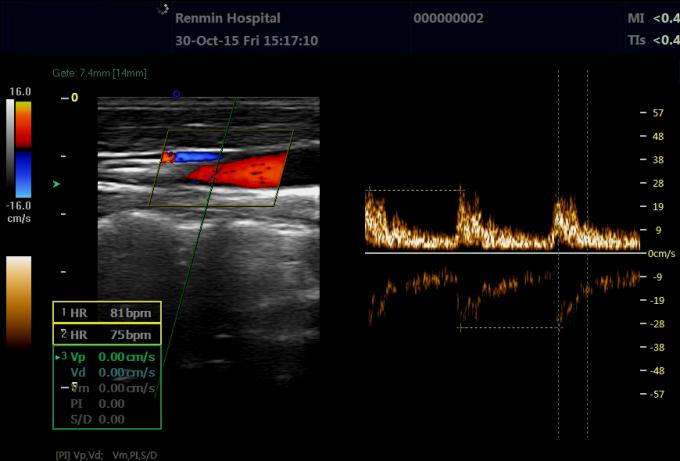 15 Inch LED Color Doppler Ultrasound Machines 60deg Scan Angle