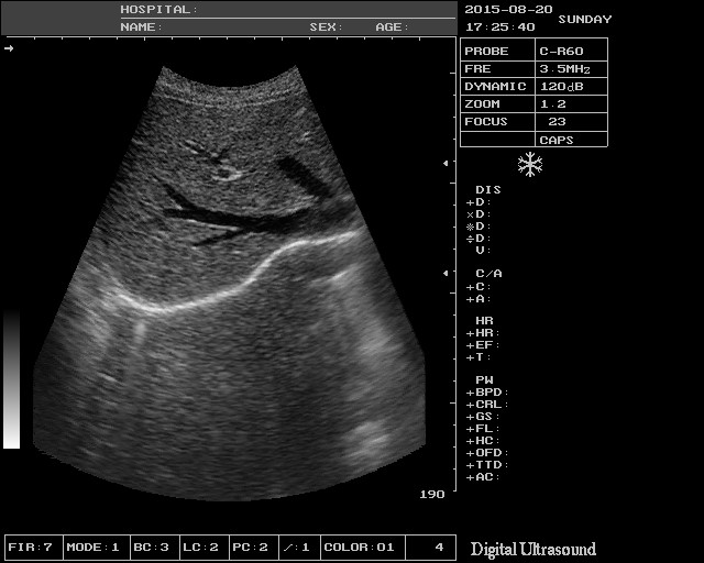 Xianfeng Laptop USG Scan Machine Ultrasound Device Li-Ion 6.5MHz R13